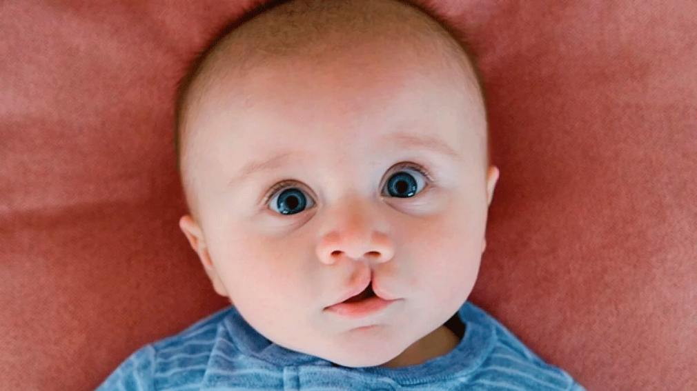 Tucumán Noticias – Agencia de Noticias - Labio leporino: estudios ...